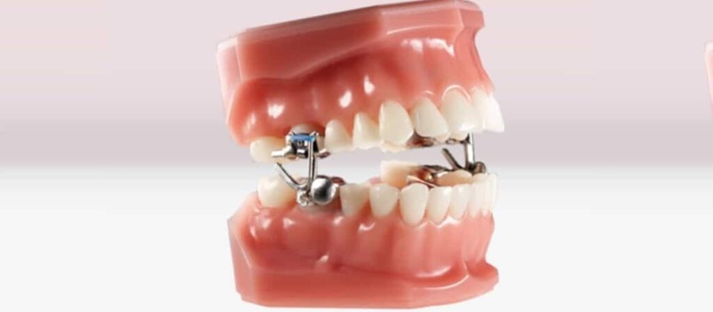 MARA instructions | How to correct your jaw with a MARA appliance | We ...