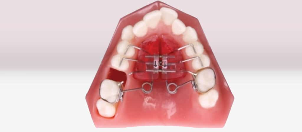 What is a Pendex appliance and how does it work? | Pendex Instructions ...